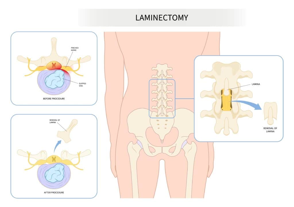 Laminectomy Without Fusion Laminectomy Without Fusion
