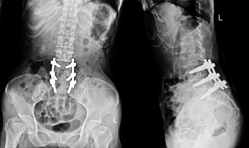 Lumbar Spondylolysis And Spondylolisthesis Surgery Research