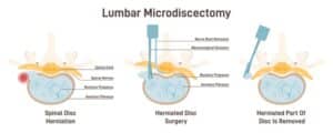 Information on lumbar discectomy for lumbar disc herniation