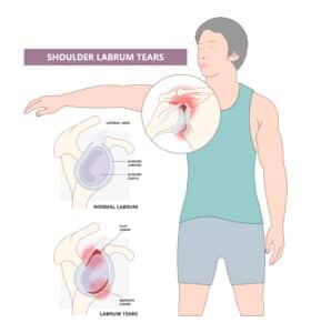 Does a shoulder labrum tear require surgery?