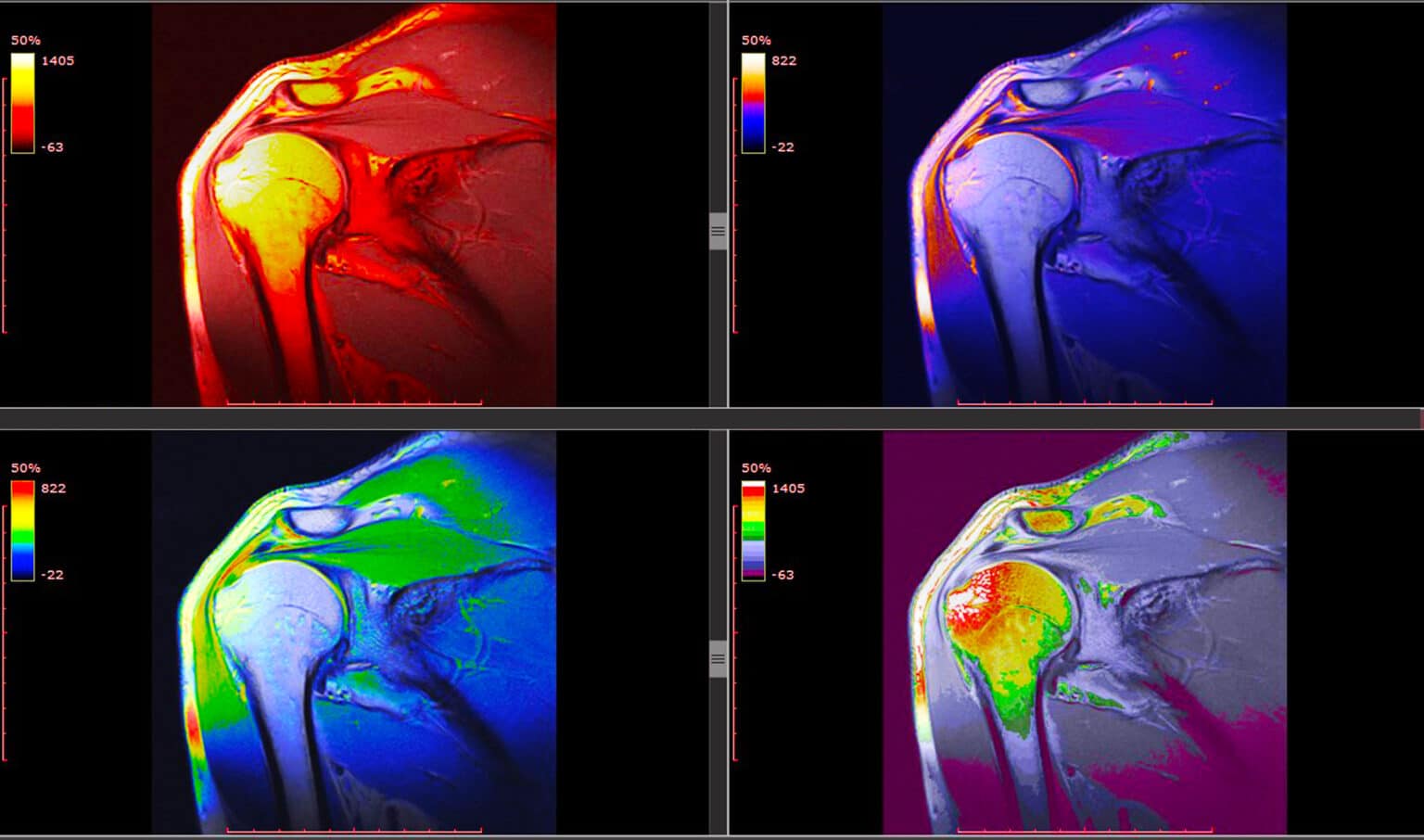 What is a normal shoulder MRI and what is an abnormal shoulder MRI?