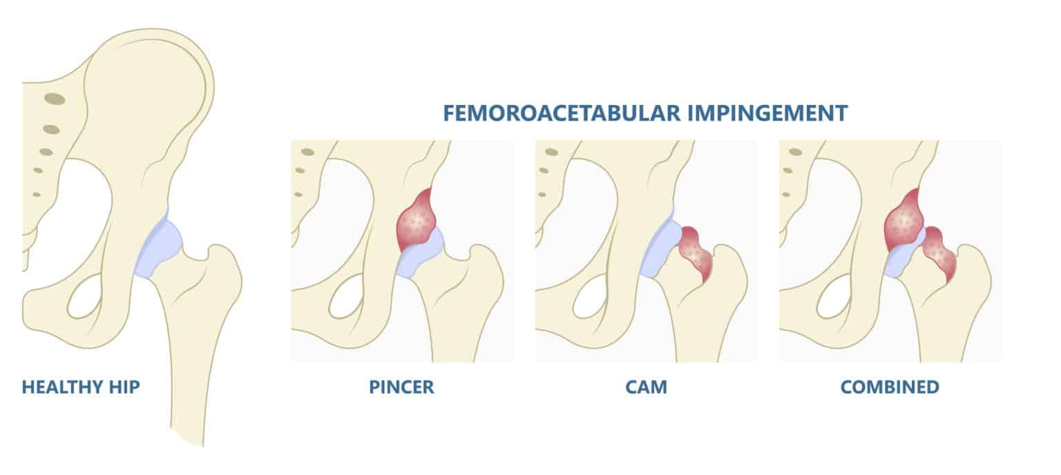 Failed Hip Arthroscopic Surgery - Joint Rehab and Sports Medical Center