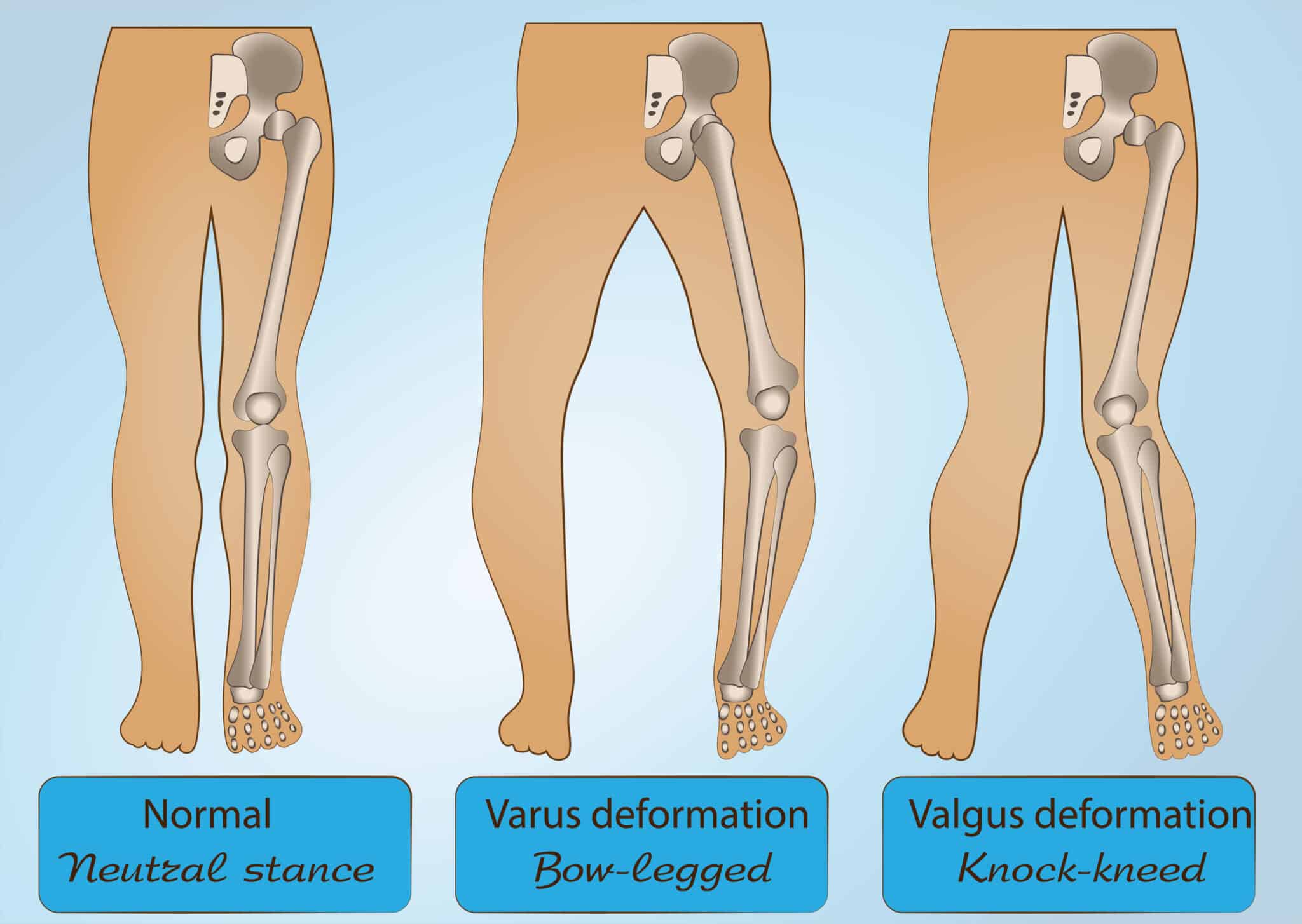 Information on Knee replacement complications