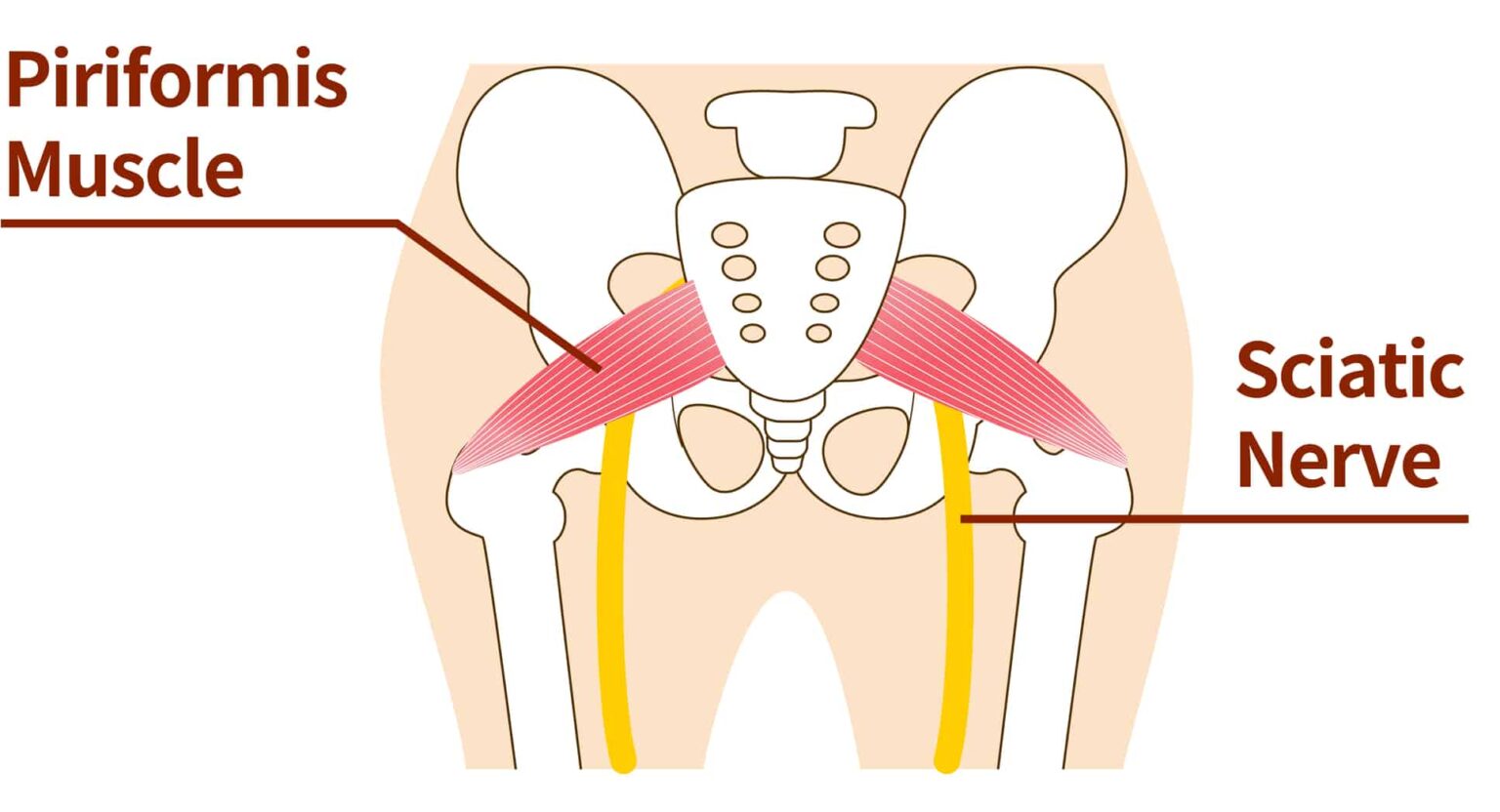 Research on piriformis syndrome and sciatic nerve entrapment
